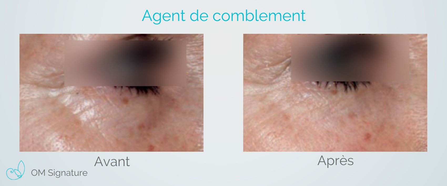 Cernes creux sous les yeux | Injection acide hyaluronique