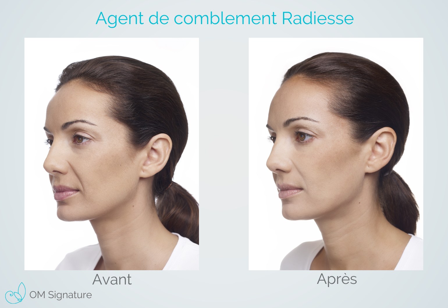 Injection de Radiesse | Clinique Médico Esthétique à St-Lambert